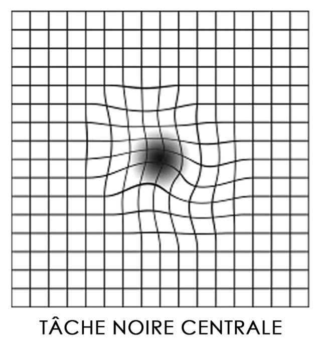 DMLA - Dégénérescence maculaire liée à l’àge - Ophtalmo Nice
